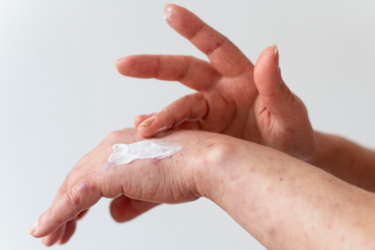 Bug Bite or Skin Infection? Know the Signs This Summer